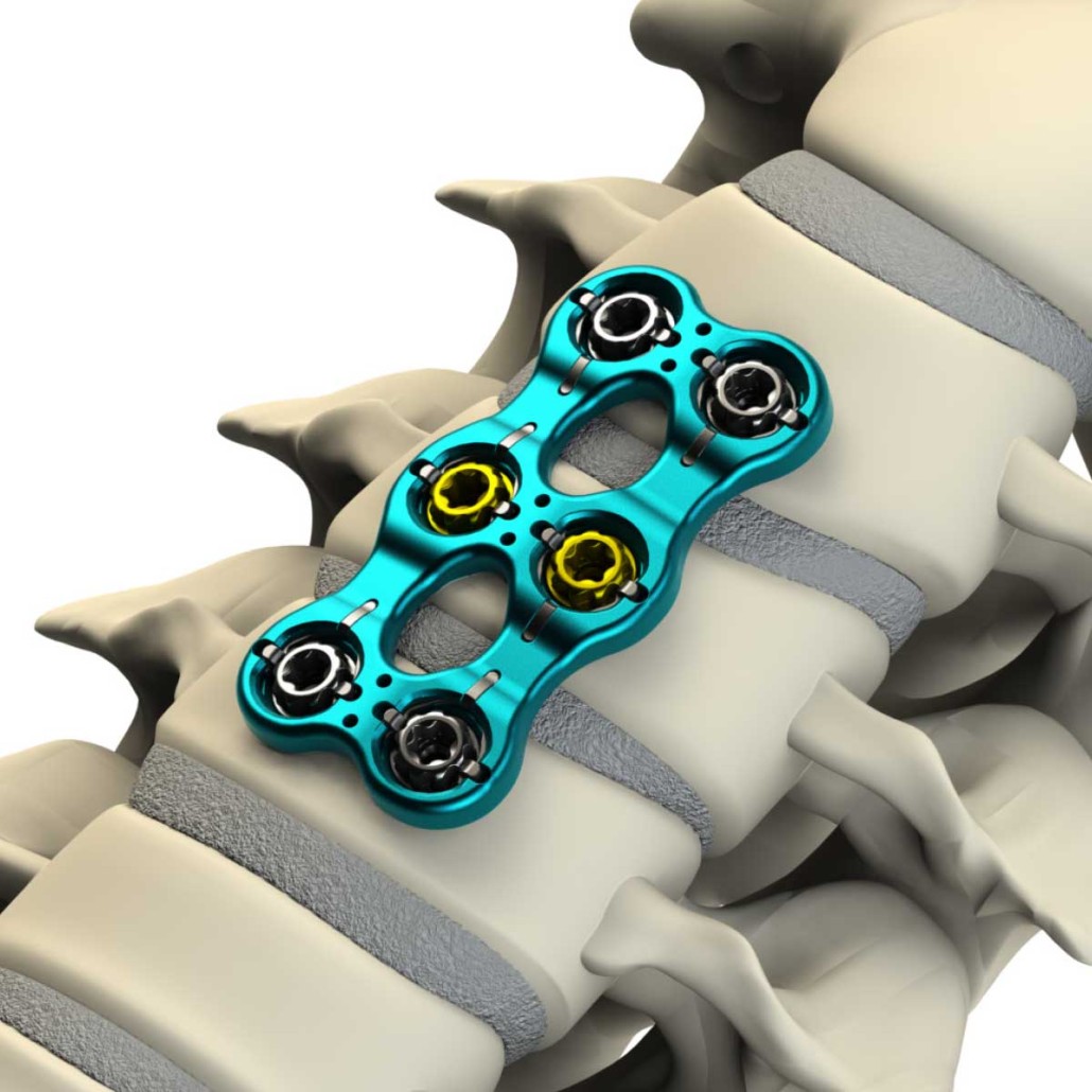 Cervical Plating System - Genesys Spine