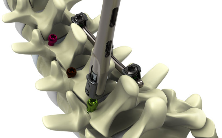 TiLock Modular Spinal System - Genesys Spine