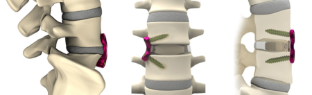 Binary Lumbar Plate System - Genesys Spine