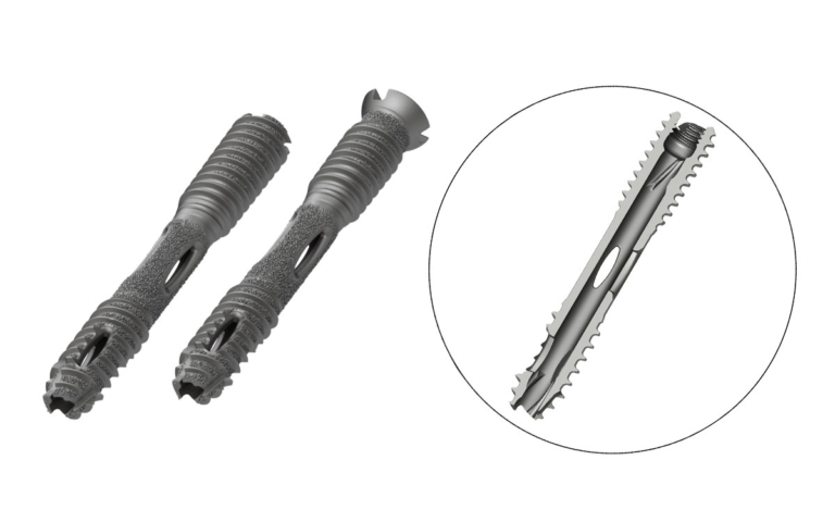 Lateral Sacroiliac Joint Fusion - SIros® 3D Printed - Genesys Spine