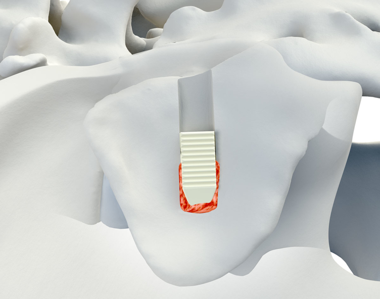 Record year for Genesys Spine SI Joint Division - Genesys Spine