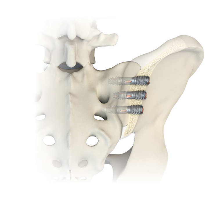 Genesys Spine Launches SIros O™ Transfixing SI Joint Fusion System ...