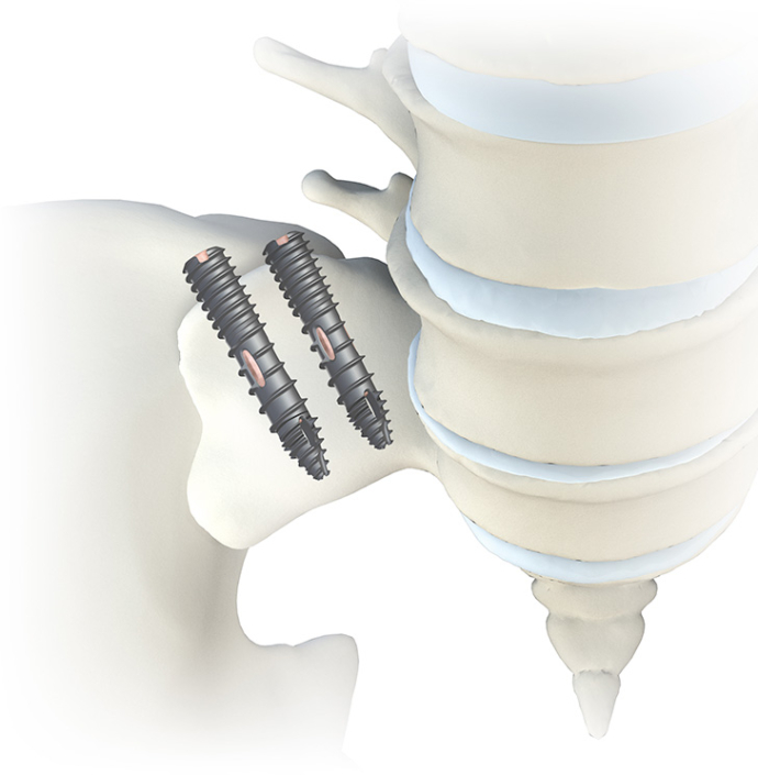 Oblique Sacroiliac Joint Fusion – SIros O 3D Printed - Genesys Spine
