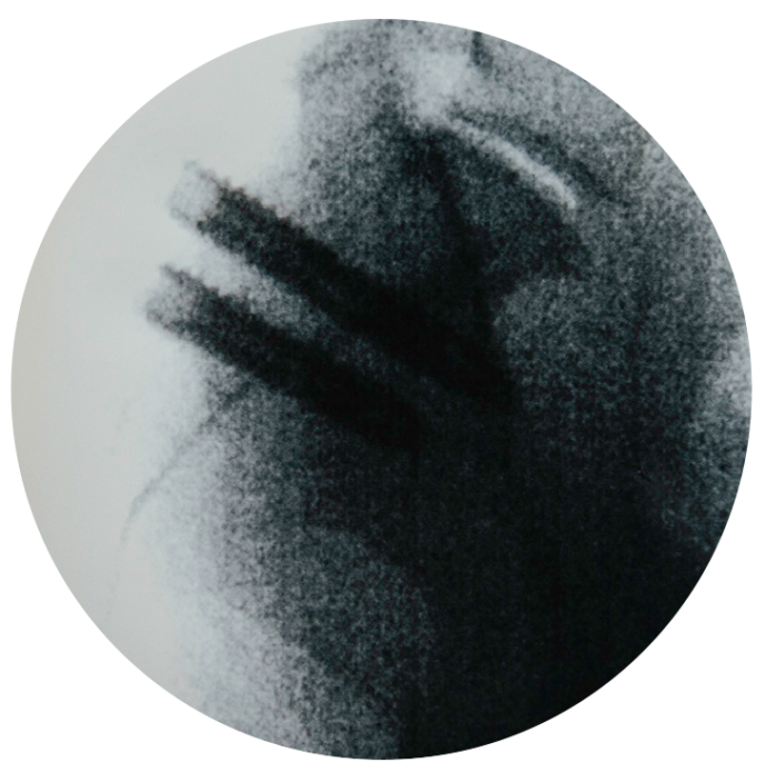 Oblique Sacroiliac Joint Fusion – SIros O 3D Printed - Genesys Spine