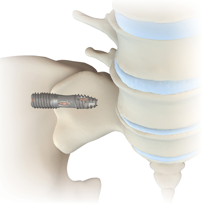 Lateral Sacroiliac Joint Fusion - SIros® 3D Printed - Genesys Spine