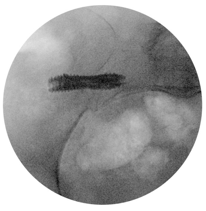 Lateral Sacroiliac Joint Fusion - SIros® 3D Printed - Genesys Spine