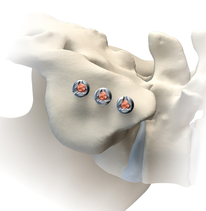 Lateral Sacroiliac Joint Fusion - SIros® 3D Printed - Genesys Spine