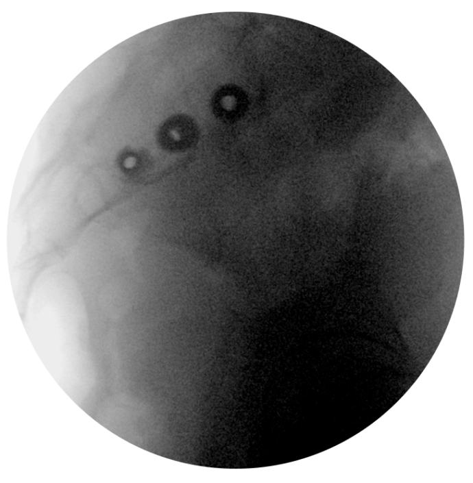 Lateral Sacroiliac Joint Fusion - SIros® 3D Printed - Genesys Spine