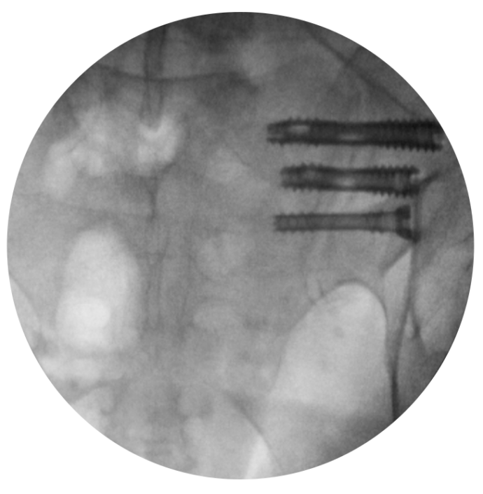 Lateral Sacroiliac Joint Fusion - SIros® 3D Printed - Genesys Spine